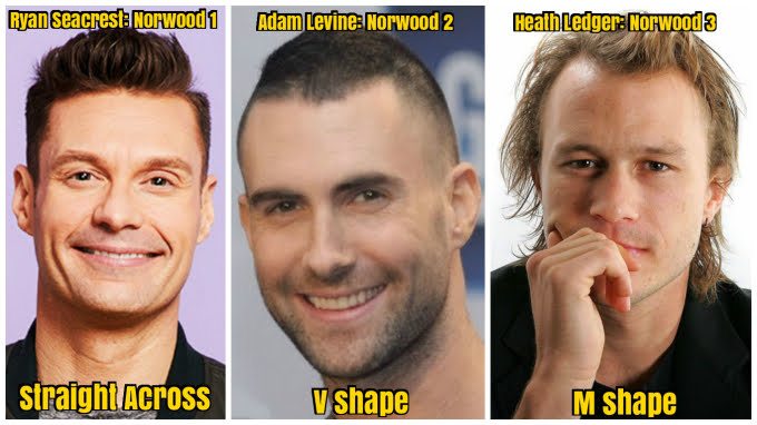 Nw2 Vs Nw3 Hairline: What Are Some Of The Key Differences | HairLossTalk Forums