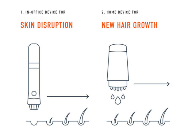 Follica's New Hair Loss Treatment Might Hurt